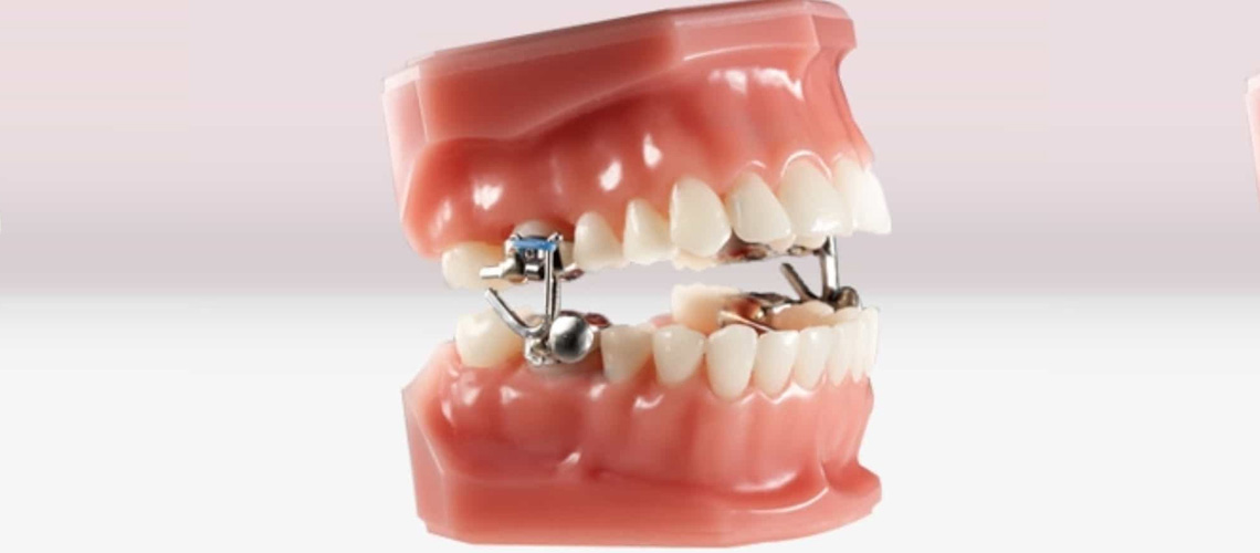 The Herbst Appliance | Your Guide to Everything You Need to Know ...